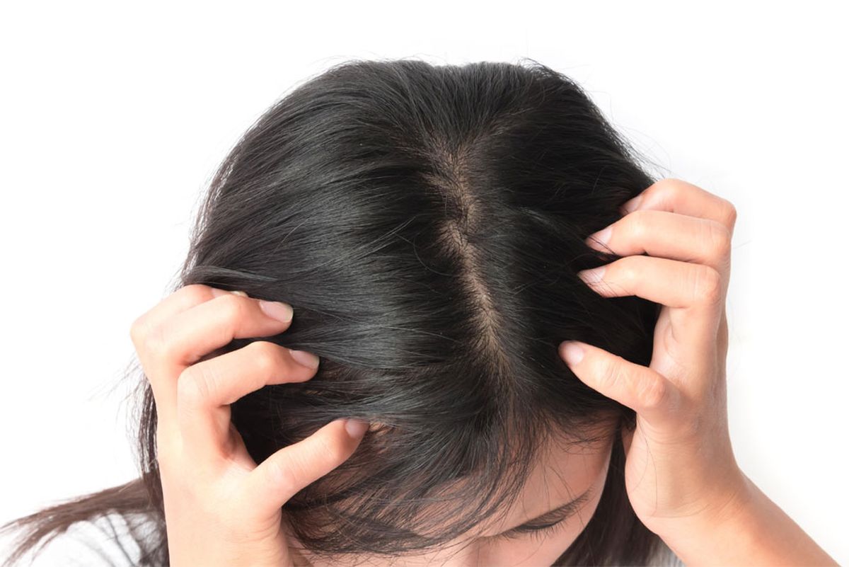 Qué significa tener caspa y cómo evitarla con este truco