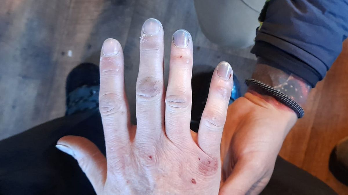 Relato de uno de los andinistas rescatados: sufrió congelamiento en sus ...