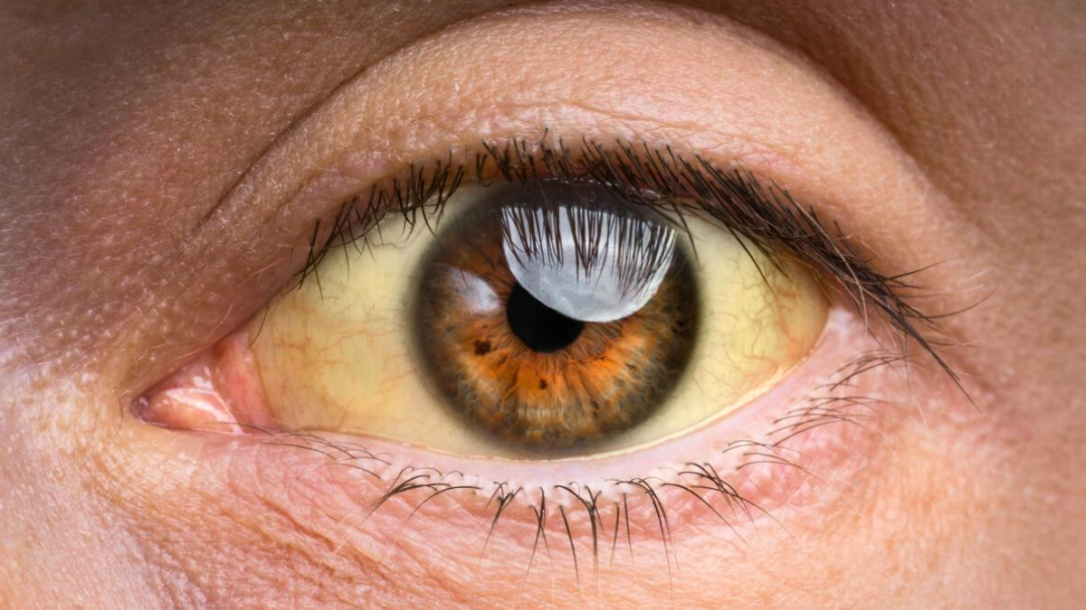 Ojos amarillos: qué significan según la medicina