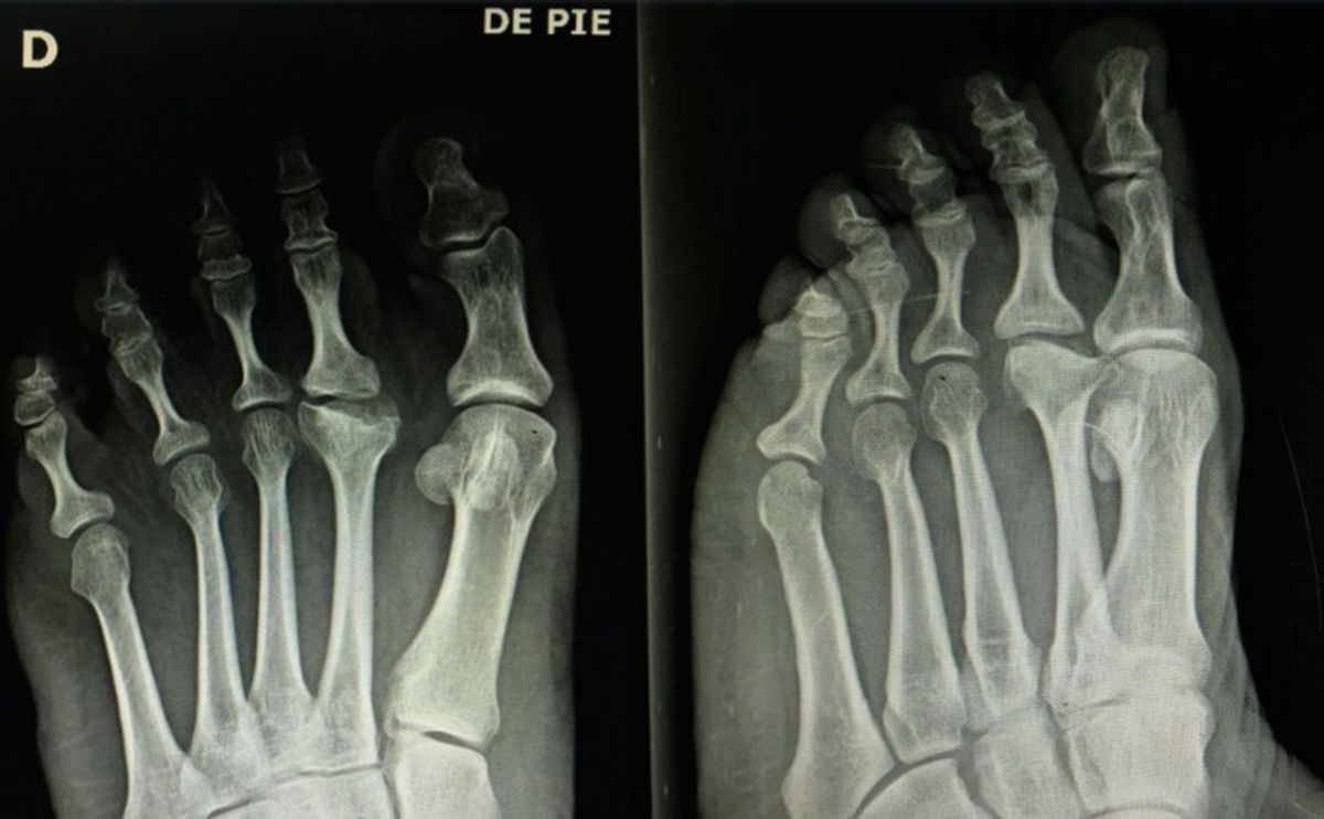 La enfermedad que podrías padecer si tienes el segundo dedo del pie más ...