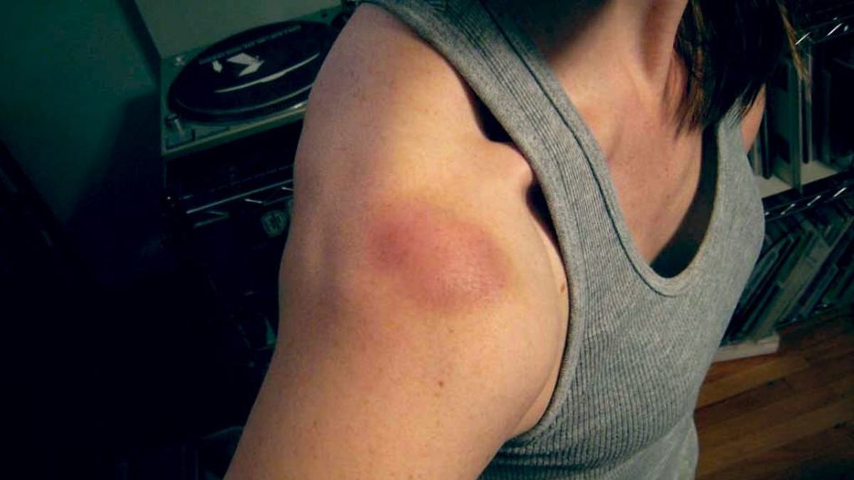 Razones por las que salen moretones con facilidad