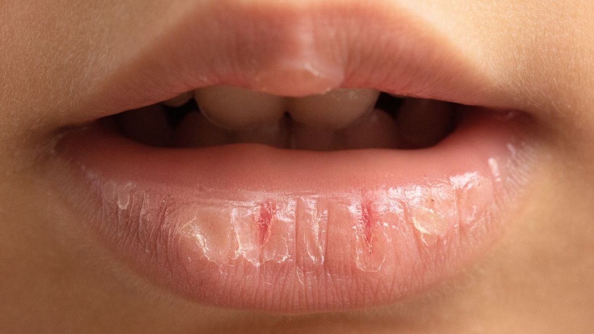 Cómo lidiar con labios secos, agrietados y sin vida: trucos y consejos ...