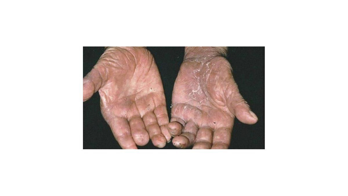 Lepra, la enfermedad que no desaparece