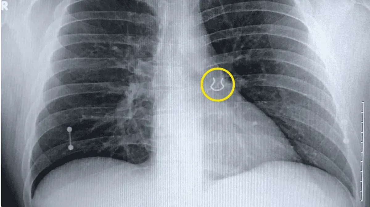 Creyó que tenía coronavirus pero le hallaron algo increíble en los pulmones