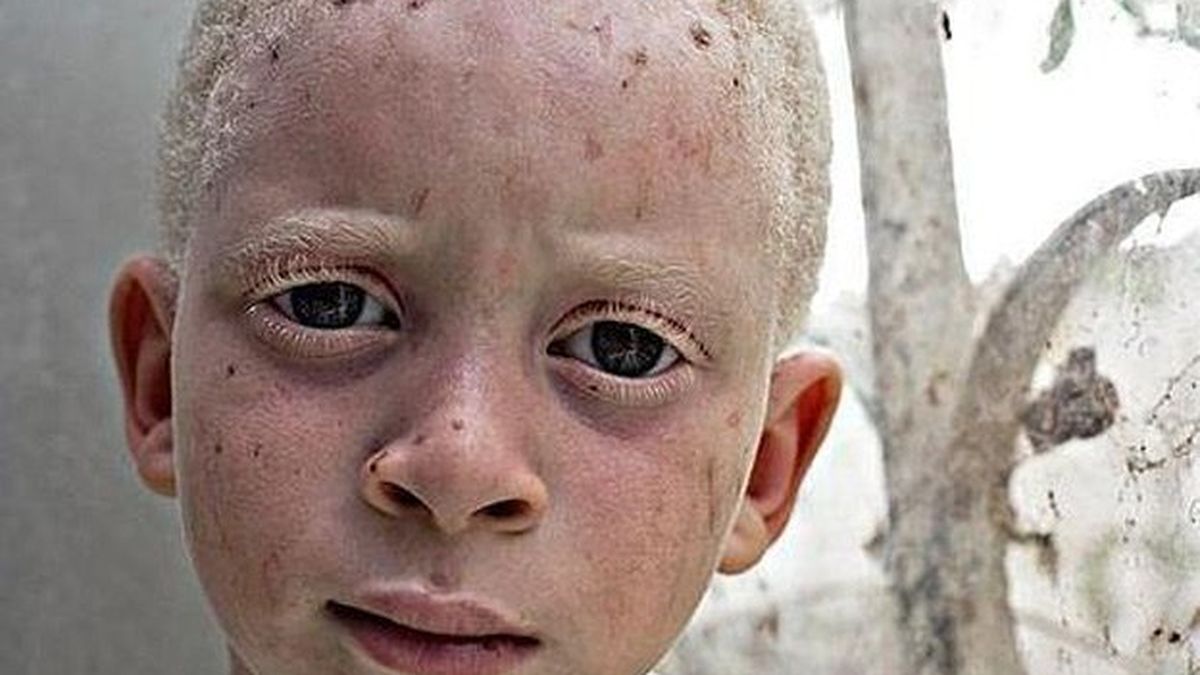 Africanos albinos, condena grabada en la piel