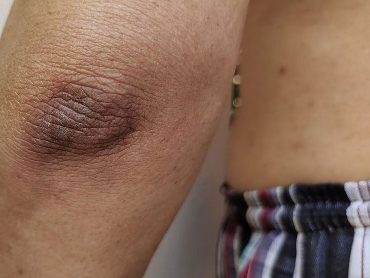 Codos negros y secos: el truco casero para recuperarlos y que no se ...