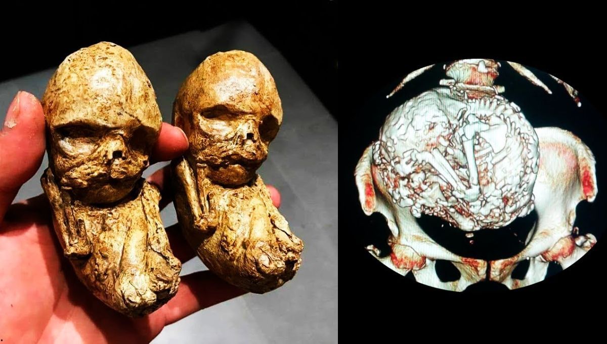 Científicos explicaron de qué se trata el fenómeno del bebé de piedra ...