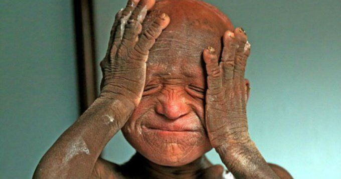 El increíble caso del nene de piedra