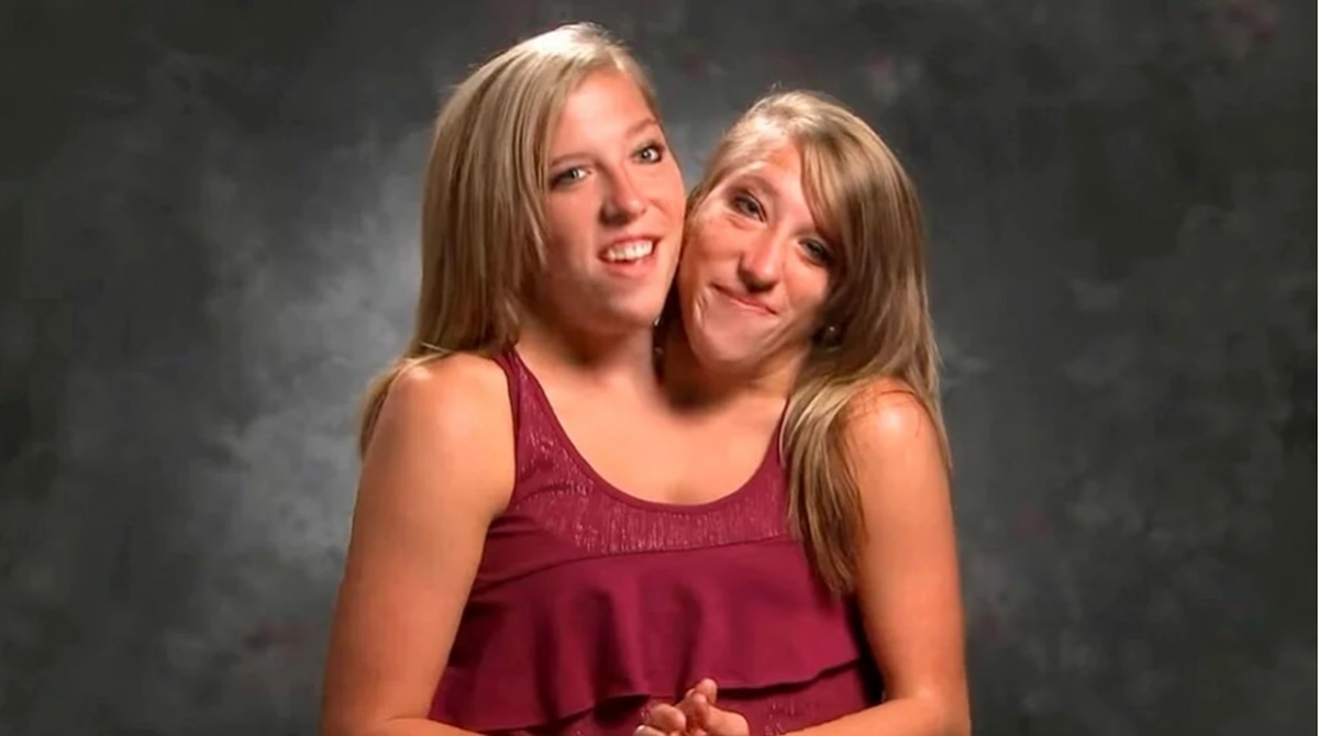 Cómo es la vida de las siamesas más famosas del mundo