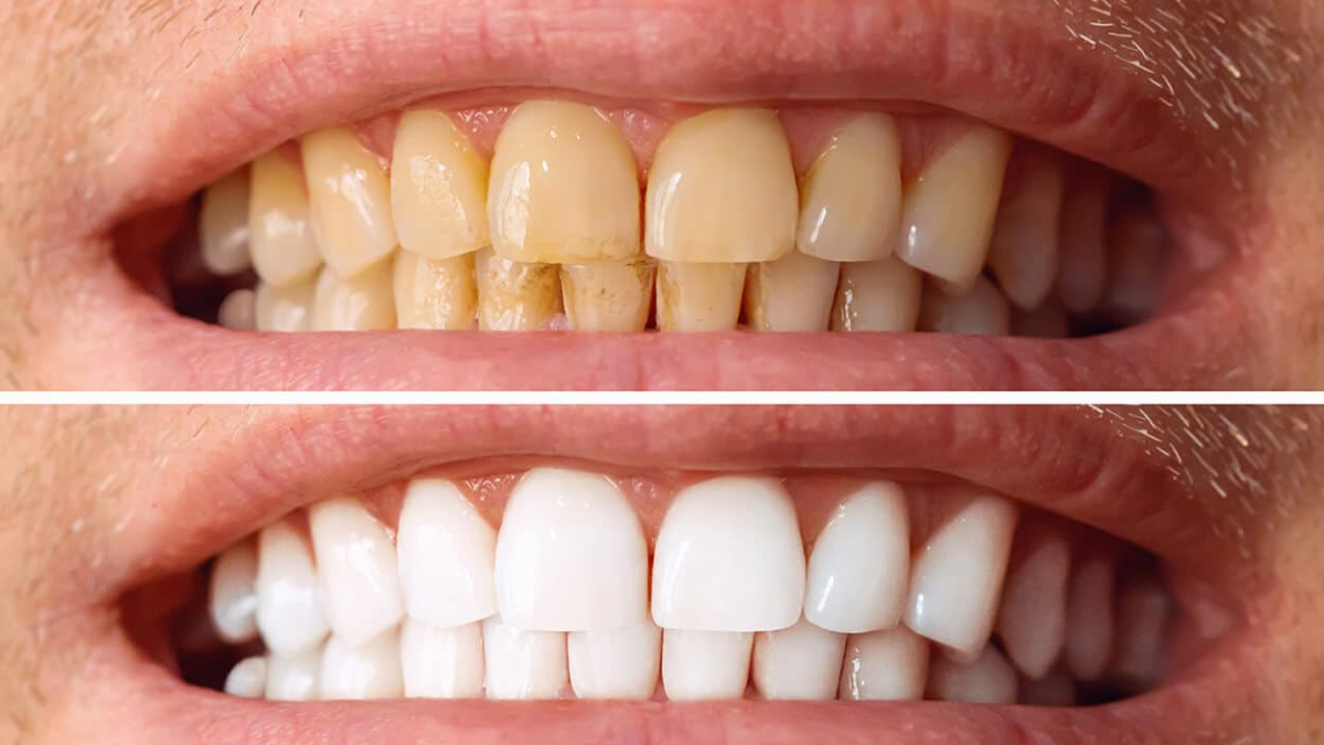 La infusión que ayuda a eliminar y prevenir el sarro en los dientes ...