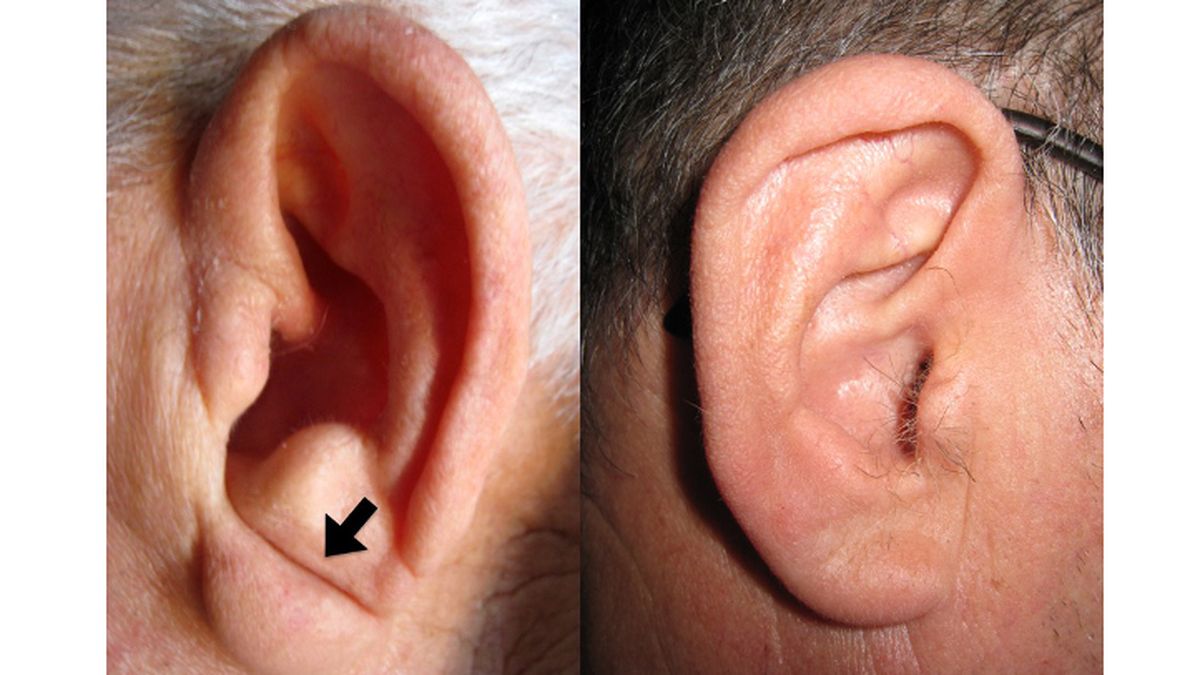 Un detalle de tus orejas puede predecir un infarto