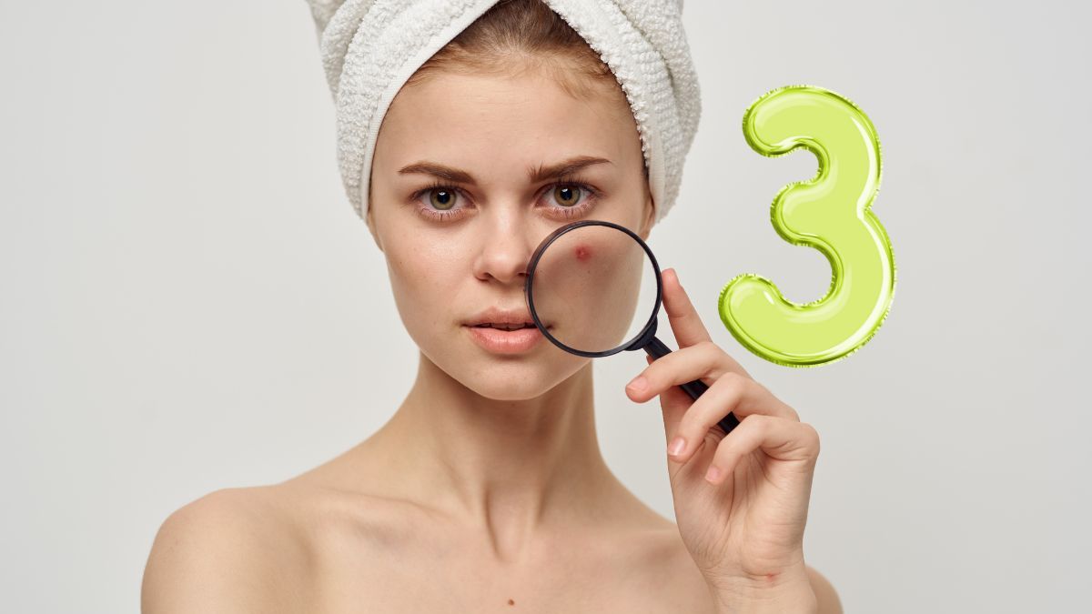 3 causas del acné que no tienen que ver con cambios hormonales