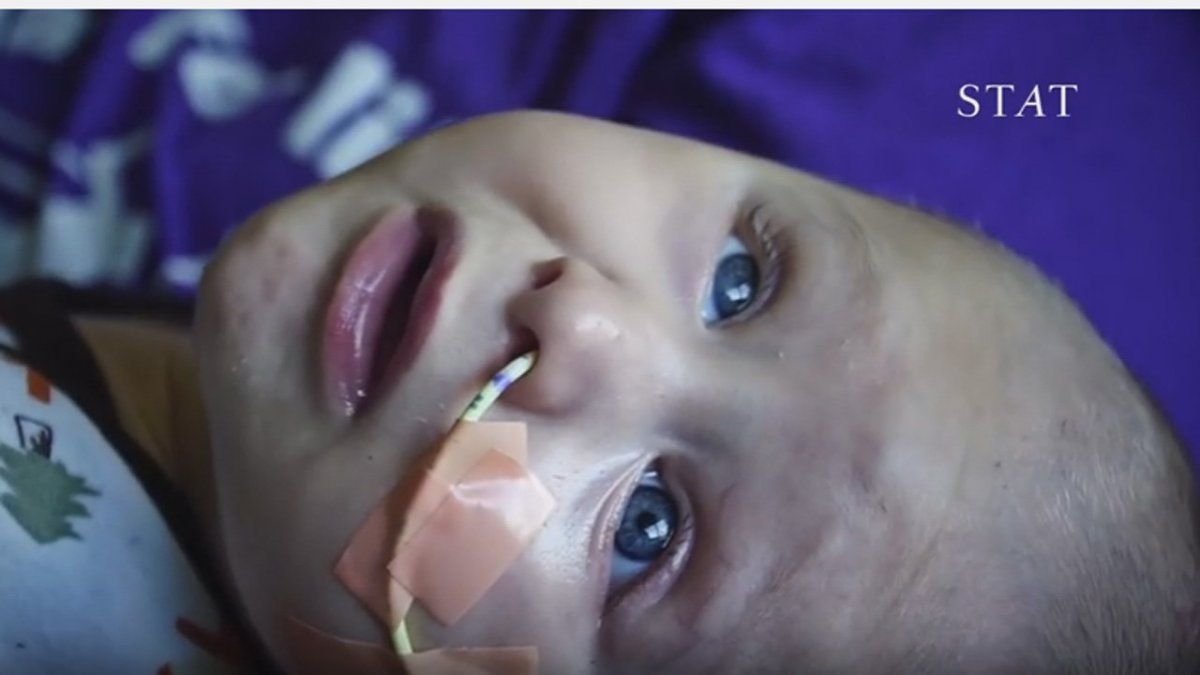 Un bebe nació con el cerebro fuera de la cabeza