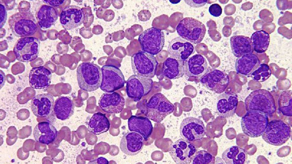 Descubren cómo un tipo de leucemia consigue llegar al cerebro