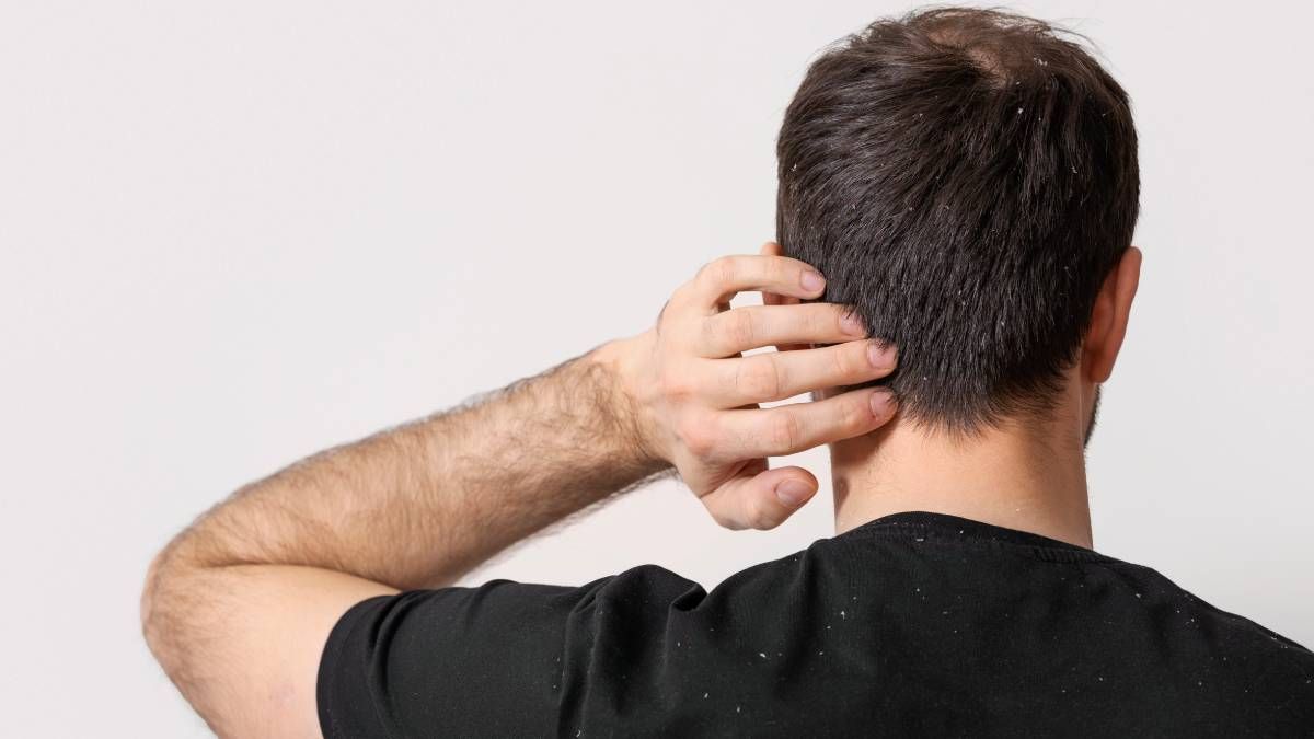 Elimina la caspa de manera natural en 5 minutos