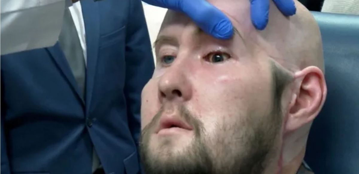 Realizaron el primer trasplante de ojo completo con éxito